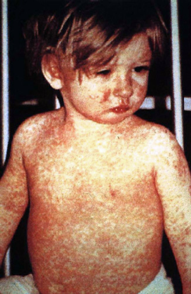 Male boginje: Preti epidemija zbog nedovoljne vakcinacije dece - Vreme